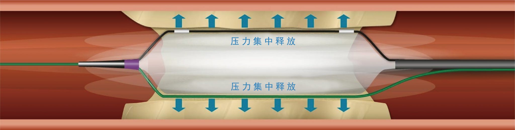 Scoreflex NC - OrbusNeich