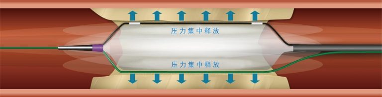 Scoreflex NC - OrbusNeich